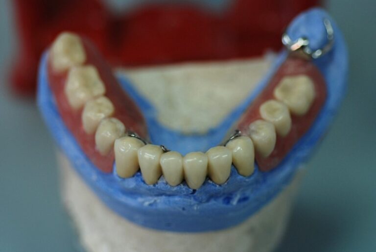 Prótesis combinadas – Manuel Peña – Especialistas en prótesis dental